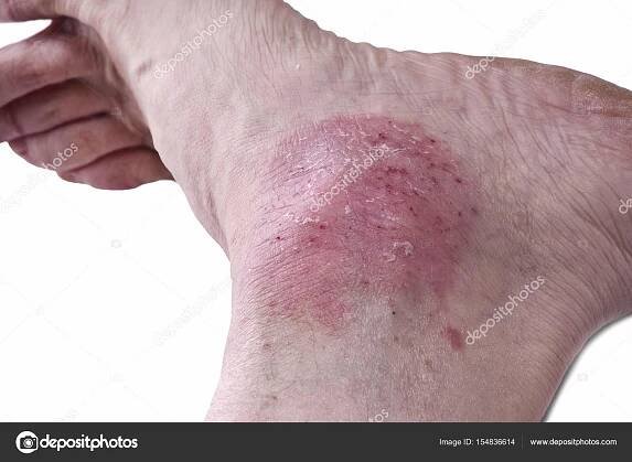 lupénka a klouby – Seznam.cz